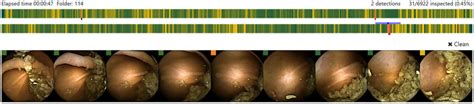 Candidate Polyp Sequence Displayed In The AI Tool Each Colored Bar Download Scientific Diagram