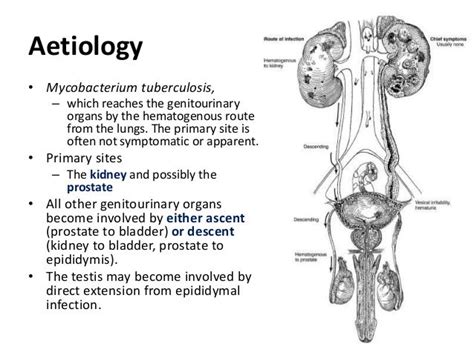 Short Review Of Genitourinary Tuberculosis