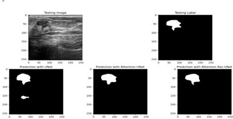 Figure 1 From Segmentation Of Cancer Masses On Breast Ultrasound Images Using Modified U Net