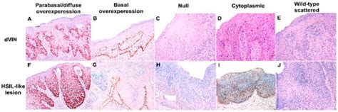 P53 Immunohistochemical Patterns In Hpv Independent Squamous Cell Carcinomas Of The Vulva And