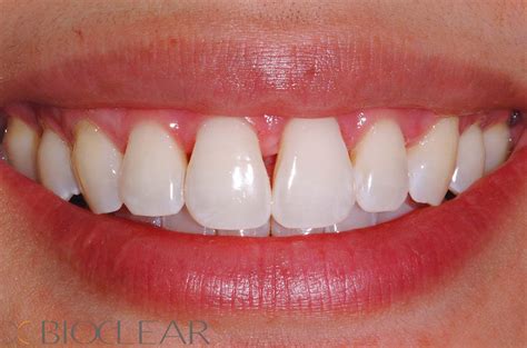 Black Triangles Diastemas Lynbrook Smiles