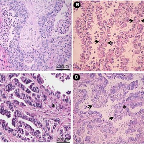 Acinar Adenocarcinoma A Papillary Adenocarcinoma B And Solid
