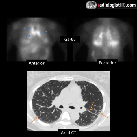 Sarcoidosis On Ct And Gallium 67 Scan R Radiology