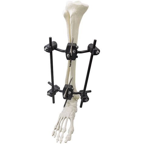 China Φ8 0 Series External Fixation Fixator Tibiaaxis Unilateral Frame Factory And