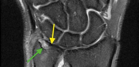 Triangular Fibrocartilage Complex Wrist Injuries Medicalobserver