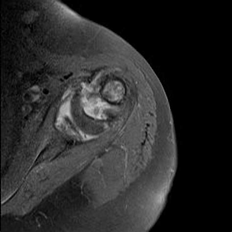 Proximal Humerus Fracture Wikidoc