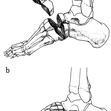 Surgical Technique A A Wedge Shaped Osteotomy Was Performed Download Scientific Diagram