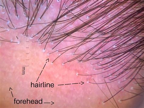 Frontal Fibrosing Alopecia And Rosacea What Is The Link Who Is