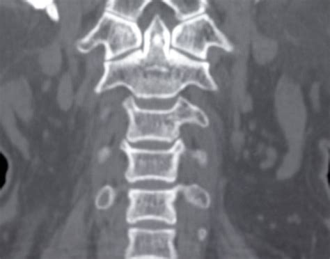 Ct Scan Of The Cervical Spine In The Sagittal Coronal And Axial Plane