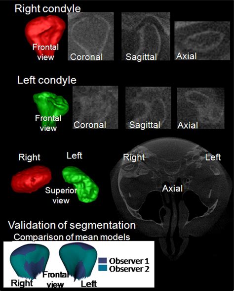 Quantification Of Condylar Resorption In Temporomandibular Joint