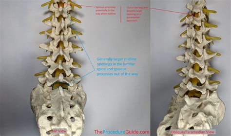 Lumbar Thoracic Epidural Catheter Insertion Technique And Overview The Procedure Guide
