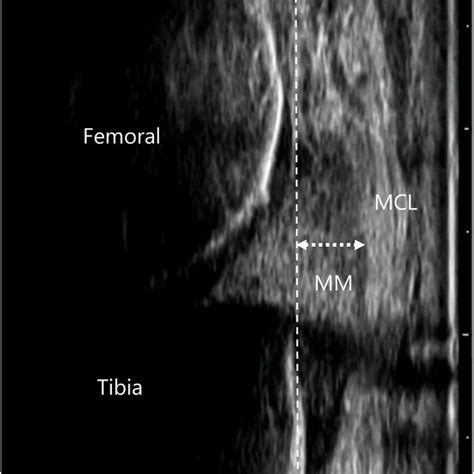 The Evaluation Of Meniscus Extrusion On Ultrasound Mm Medial Meniscus