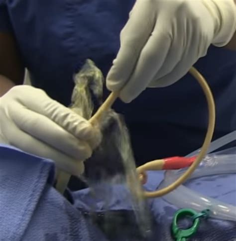 Suprapubic Catheter Spc