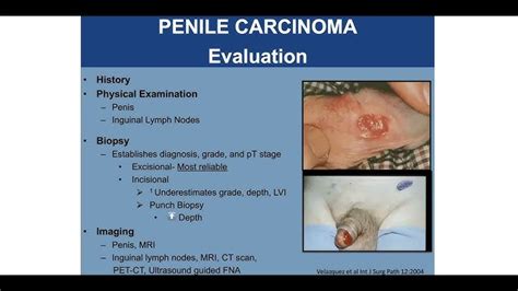 Penile Cancer Early Stages Pictures Multiple Penile Schwannomas