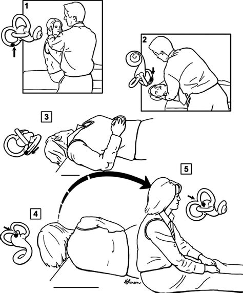 Posterior Canal Canalith Repositioning Maneuver Newly Classified
