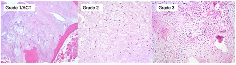 Microscopic Images Chondrosarcoma Grading Is Based On The Cellularity