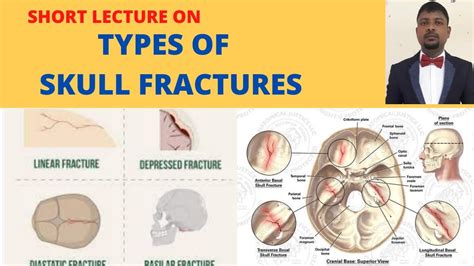 Linear Vs Basilar Skull Fracture At Isaac Oppen Blog