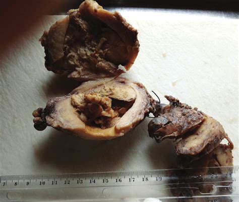 A Friable Grayish White Mass Filling The Endometrial Cavity With A Download Scientific Diagram