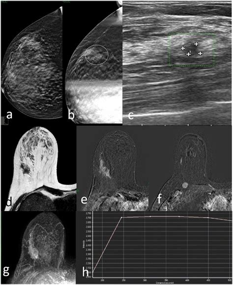 Dbt Right Craniocaudal A And Dbt Spot Compression B Tomosynthesis Download Scientific