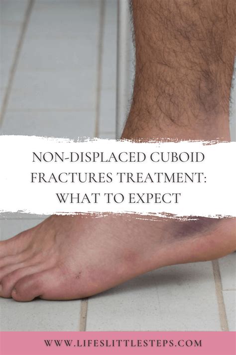 Displaced Navicular Fractures An Overview Of Navicular Fracture Treatment Artofit