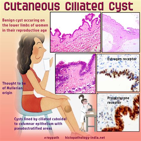 Cutaneous Ciliated Cyst Pathology Cysts Dermatology