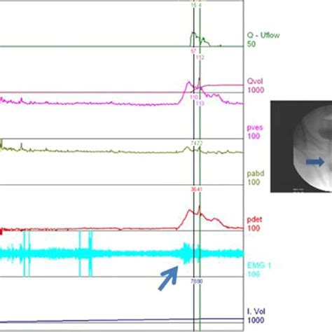 Video Urodynamic Study In A Man With Lower Urinary Tract Symptoms Download Scientific Diagram