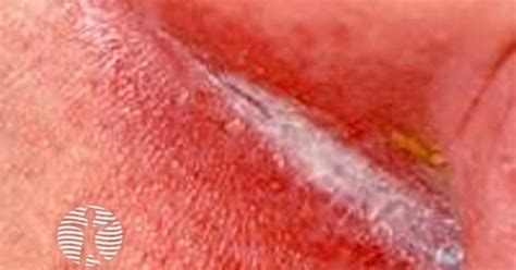 Flexural Psoriasis Image