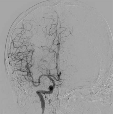 Digital Subtraction Angiography Performed 3 Days After The Onset Download Scientific Diagram