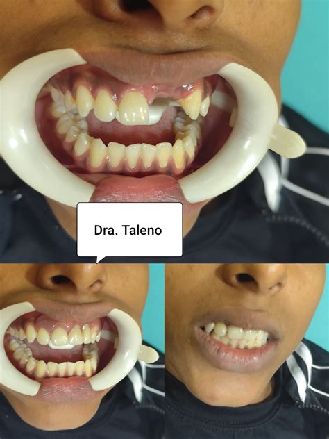 Clinica La Prótesis Removible Valplast Es Una Excelente Opción Para