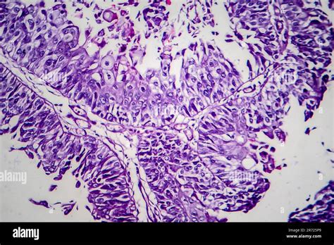 Bladder Transitional Cell Carcinoma Light Micrograph Photo Under