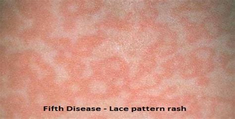 Erythema Infectiosum Lacy Rash Slapped Cheek Or Fifth Disease