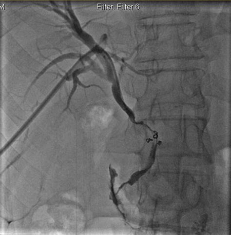 Cholangiogram Cpt Post Operative Outcomes For Patients With