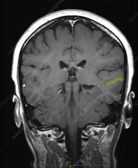 Superior Temporal Sulcus Highlighted Mri Stock Image C039 3591 Science Photo Library