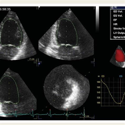 Three Dimensional Echocardiography Left Ventricular Data Sets Obtained Download Scientific