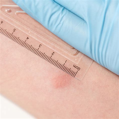 Types Of Tb Tests Ppd Printable Forms Free Online