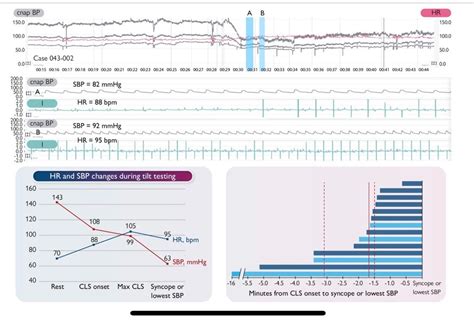 How Closed Loop Stimulation Cls Pacing Prevents The Recurrence Of