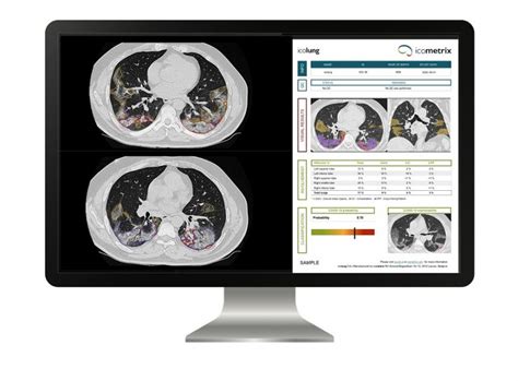 Ai Lung Scan Analysis Rolled Out Across Europe • Healthcare In