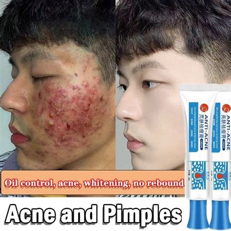 Effective Acne Cream Acne Scar Remover Pimple Remover Skin Care Anti Acne Treatment Face