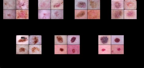 Samples Images From The Seven Skin Lesion Classes Download