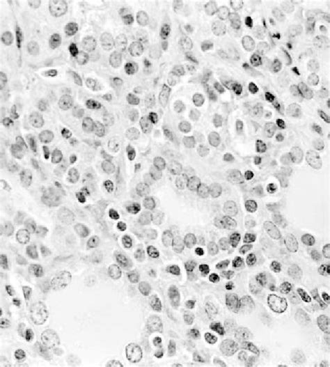 Thyroid Gland Macrofollicular Adenoma Semantic Scholar