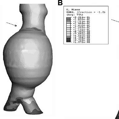Example Of An AAA Model From A Single Patient In The Absence A Download Scientific