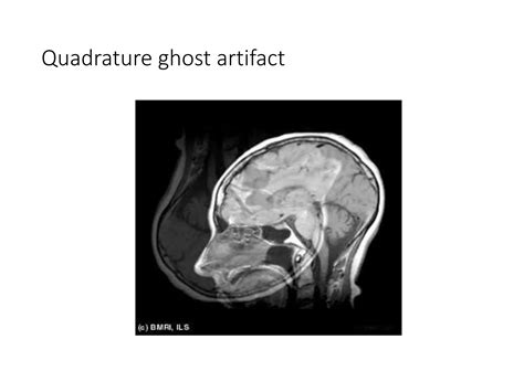 Mri Artifacts Introduction Classification Types Ppt