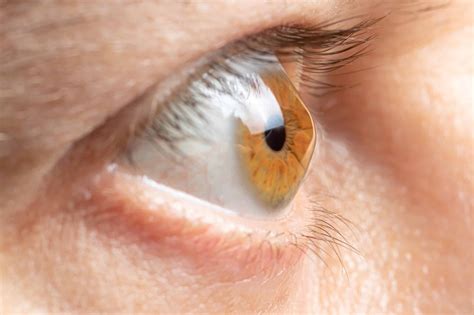 Keratoconus Cross Linking