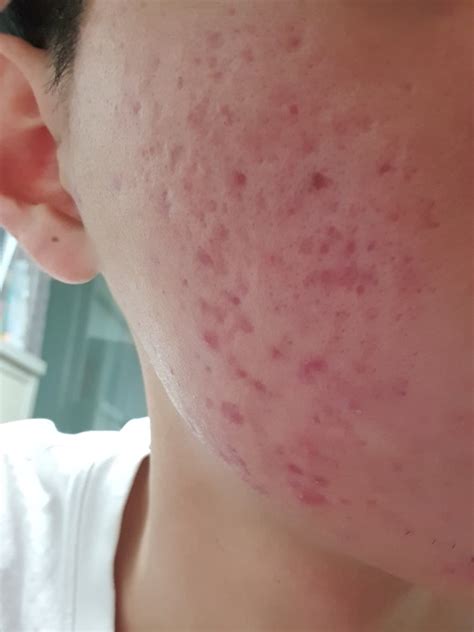 여드름 패인 흉터 화장 지식in