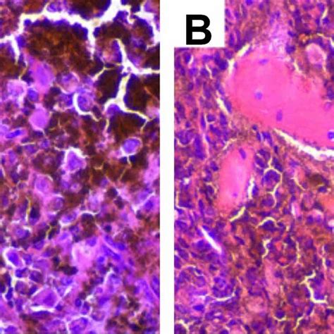 Histopathologic Findings A Polymorphic Neoplastic Cells With Clear Or Download Scientific