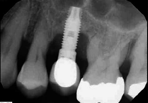 Loss Of Interproximal Contacts Resulting In Food Trap And Peri‐implant