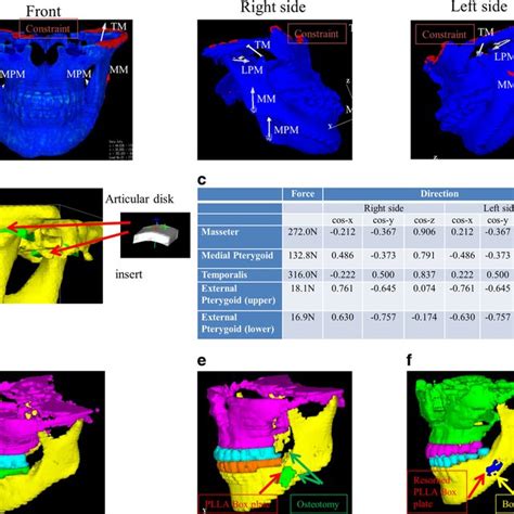 Finite Element Model Fem A Computed Tomography Ct Based Fem Of The Download Scientific