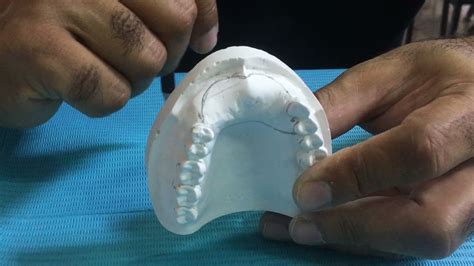 Max Class Iv Acrylic Rpd Designing On Cast Youtube