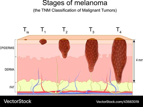 Melanoma Cancer Stages At Phoebe Grieve Blog