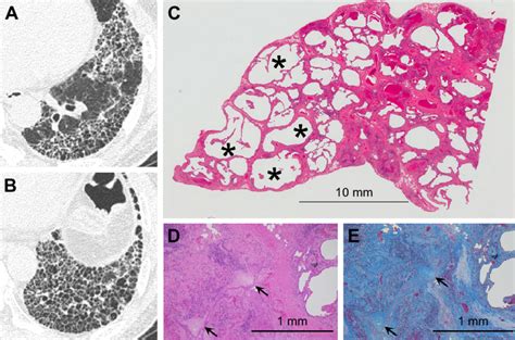 Uip Pattern On Thin Section Ct Images And Histological Findings Notes
